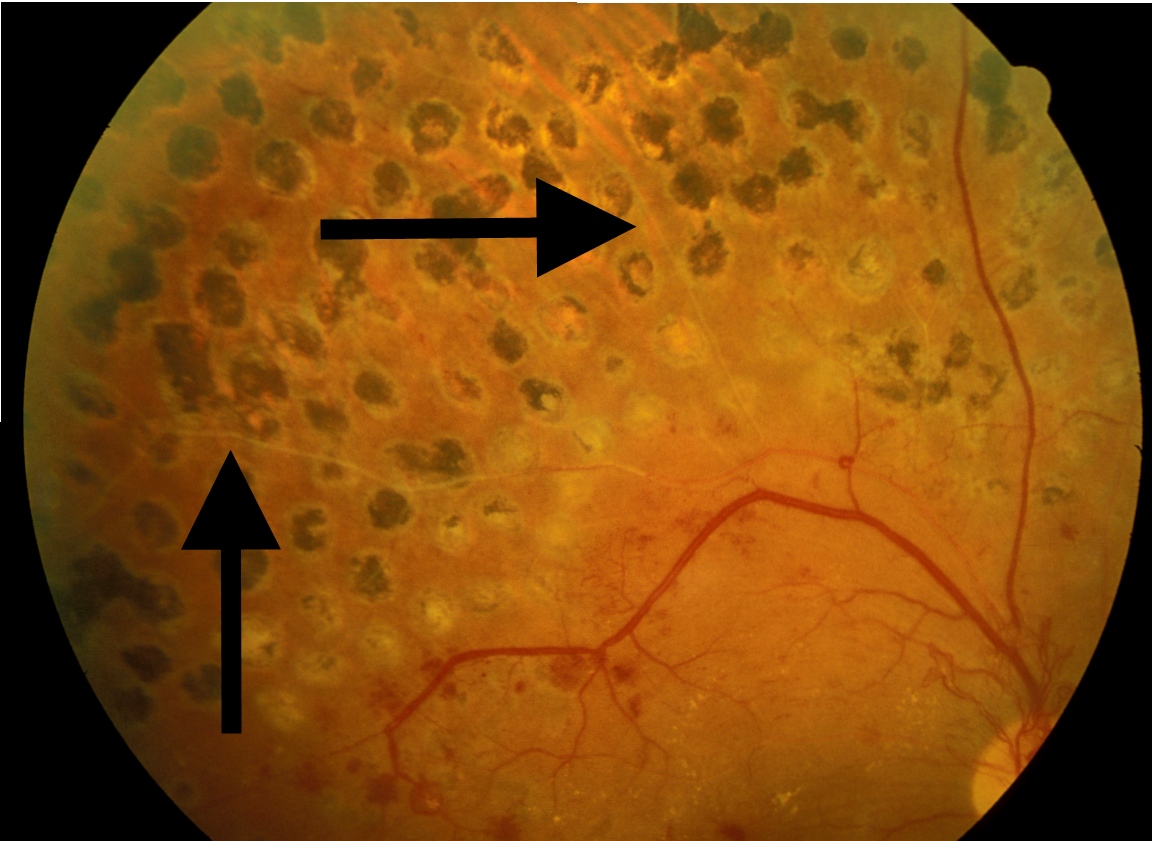 View Of Laser Scars Endotext